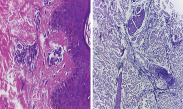 New Treatment for Muckle-Wells Syndrome Offers Hope for Those Suffering ...